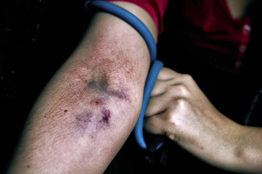 What Do Track Marks Look Like? | United Recovery Project